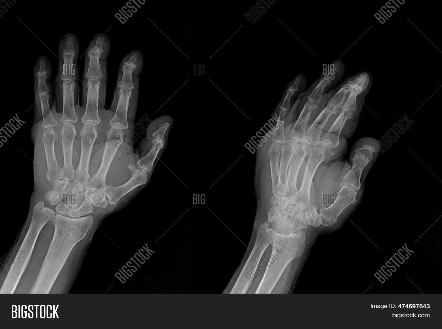 X-ray Two Projections Image & Photo (Free Trial) | Bigstock