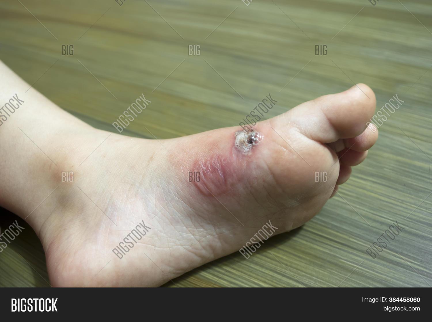 Burn On Foot Child. Image & Photo (Free Trial) | Bigstock