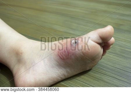 Burn On Foot Child. Image & Photo (Free Trial) | Bigstock