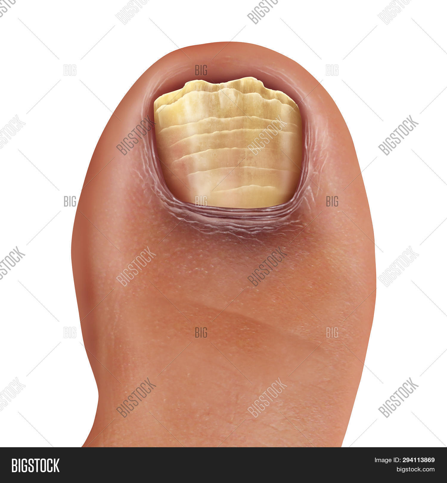 Infected Fungal Toe Image & Photo (Free Trial) | Bigstock