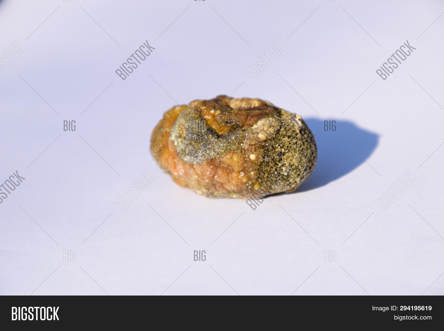 Stone Gallbladder. Image & Photo (Free Trial) | Bigstock