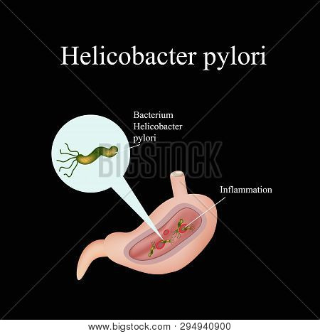 Helicobacter Pylori Vector & Photo (Free Trial) | Bigstock