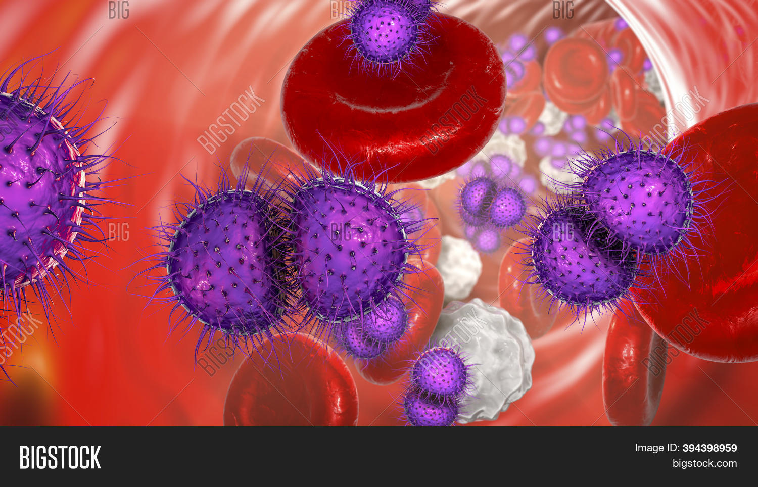 Meningococcemia, Image & Photo (Free Trial) | Bigstock