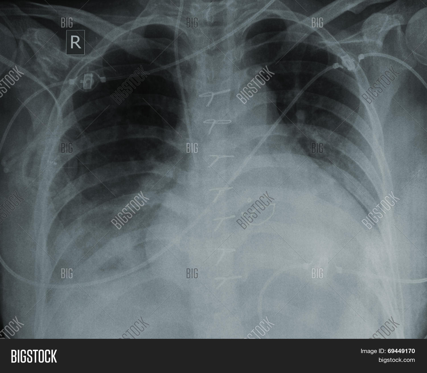 X-ray Patient Heart Image & Photo (Free Trial) | Bigstock