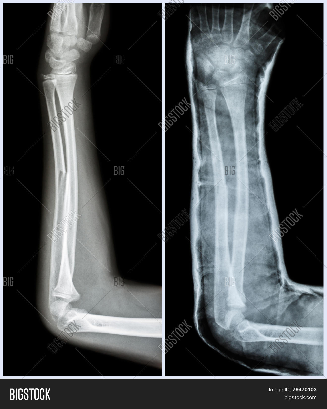 Fracture Shaft Ulnar Image & Photo (Free Trial) | Bigstock