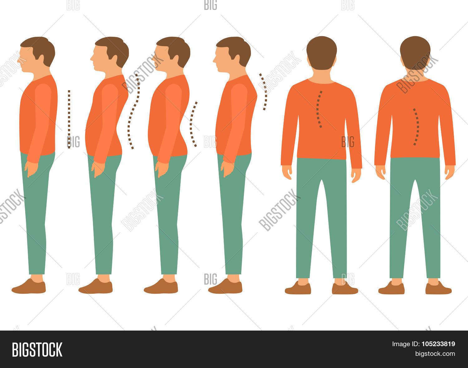 Scoliosis, Lordosis Vector & Photo (Free Trial) | Bigstock