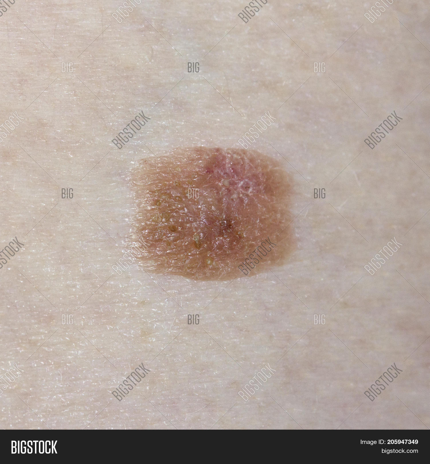 Moles Small Coloured Image & Photo (Free Trial) | Bigstock