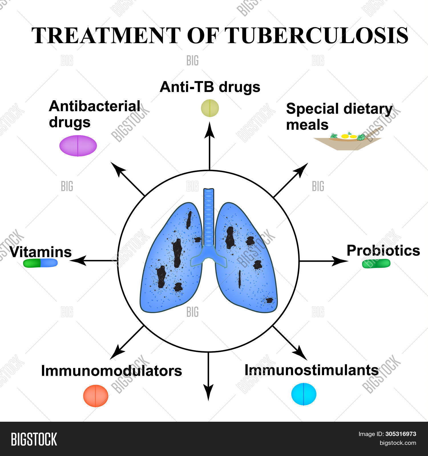 Treatment Tuberculosis Image & Photo (Free Trial) | Bigstock