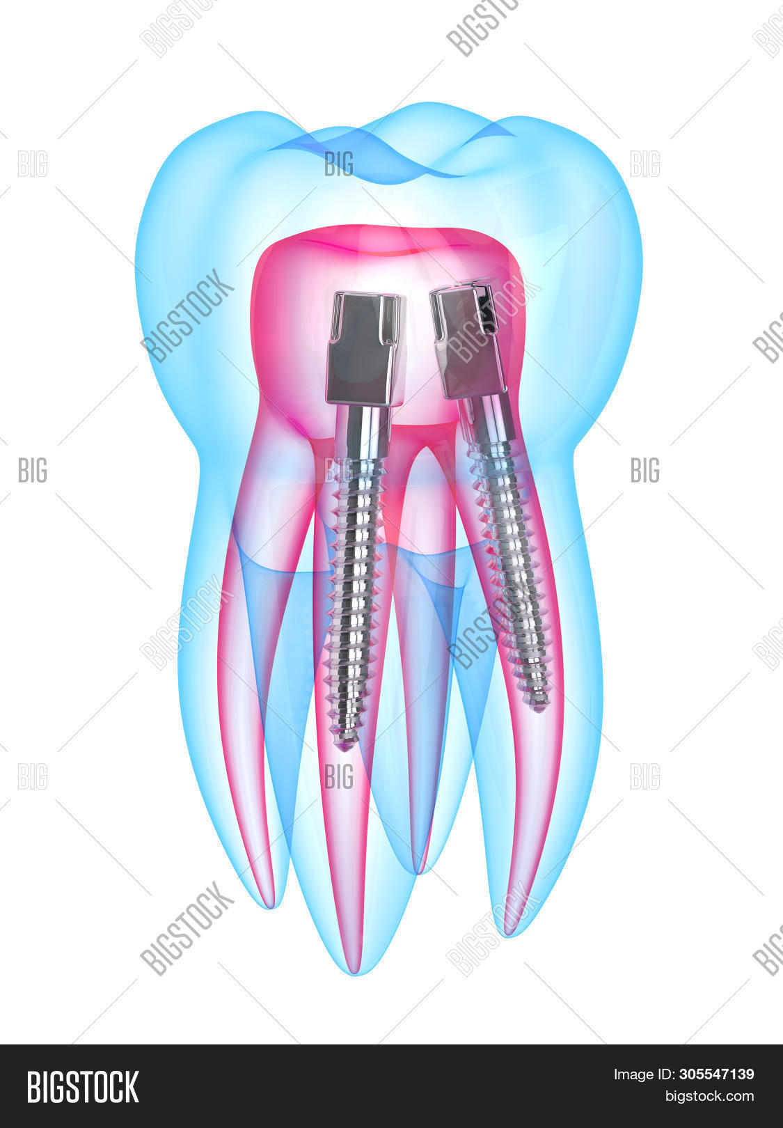 3d Render X-ray Tooth Image & Photo (Free Trial) | Bigstock