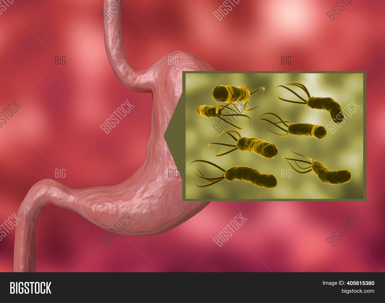 Helicobacter Pylori Image & Photo (Free Trial) | Bigstock