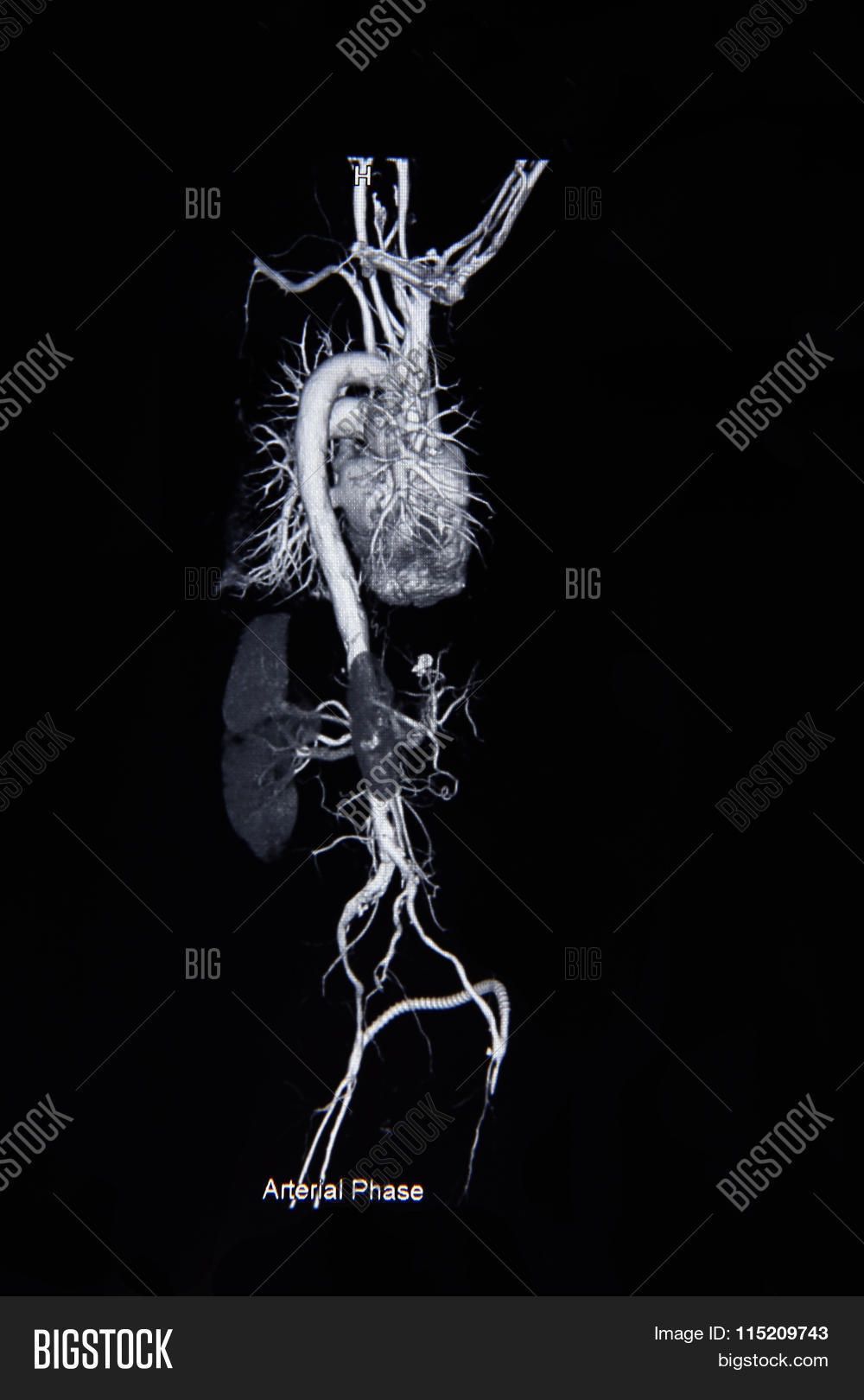 Ct Scan Angiogram ( Image & Photo (Free Trial) | Bigstock