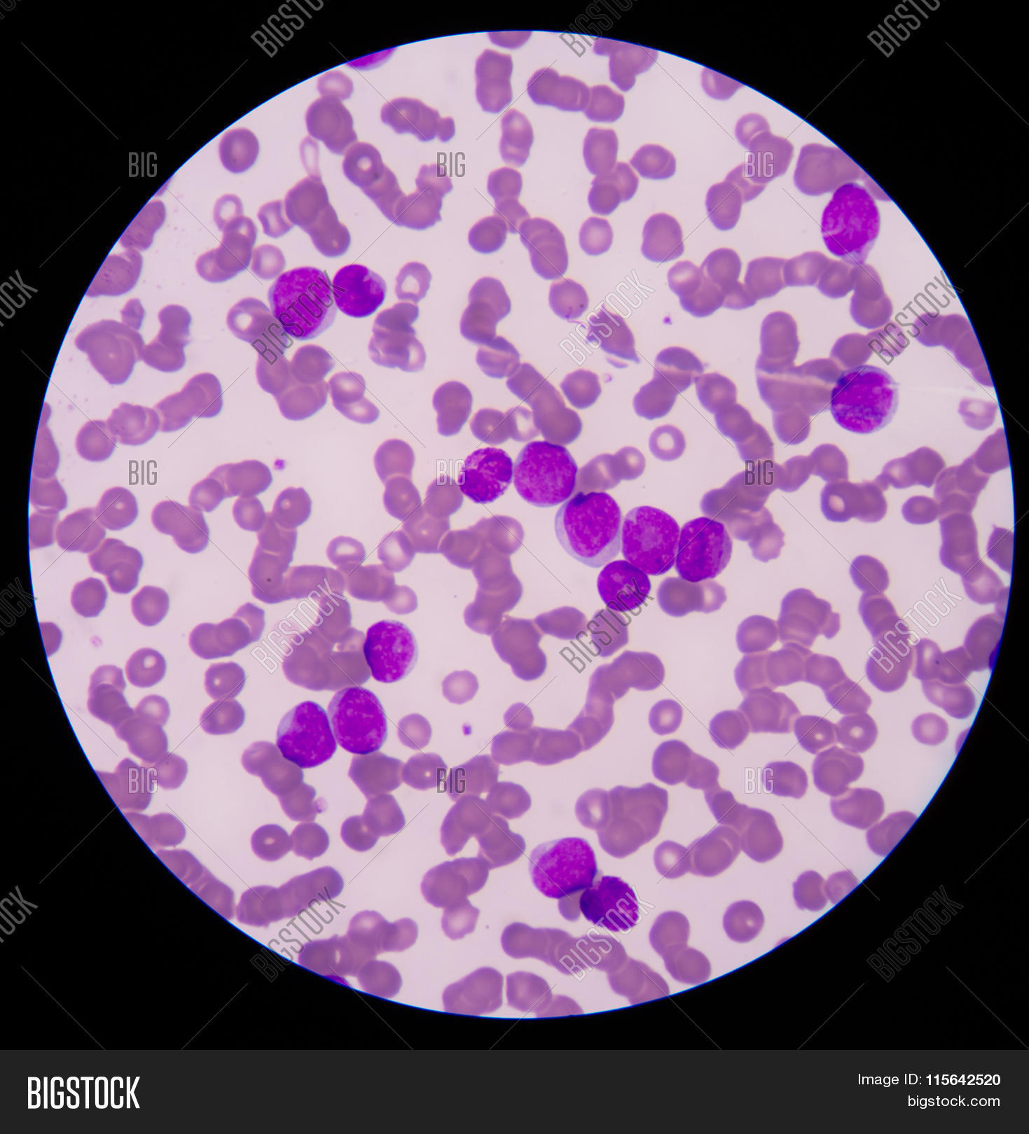 Blood Cancer. Smear Image & Photo (Free Trial) | Bigstock