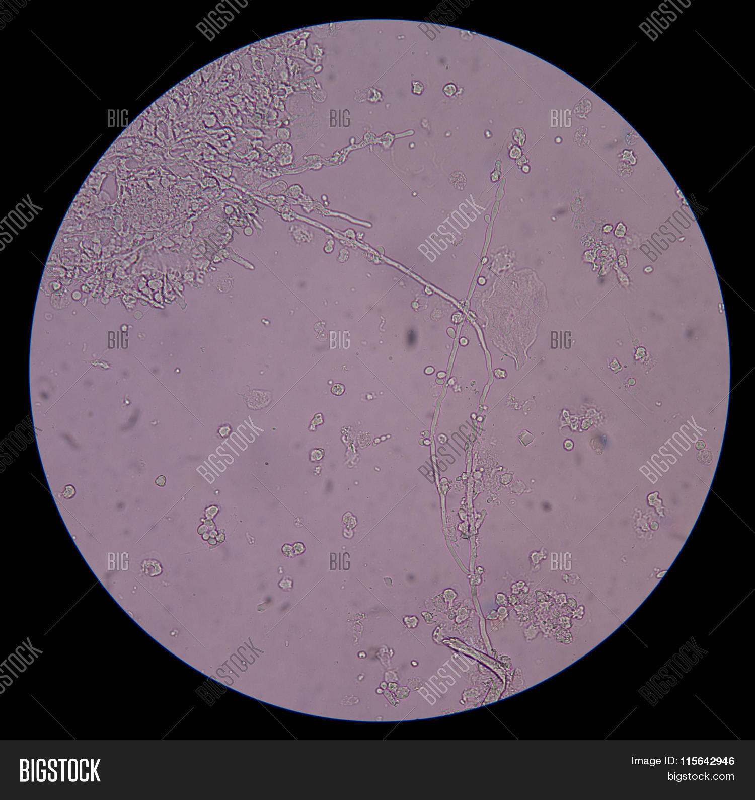 Yeast Cells In Urine