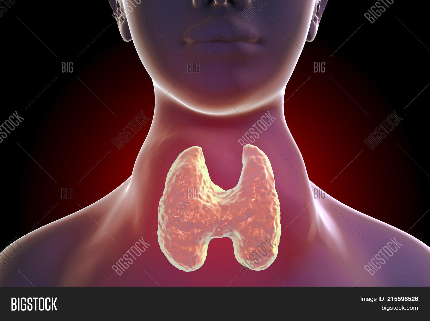Toxic Diffuse Goiter, Image & Photo (Free Trial) | Bigstock
