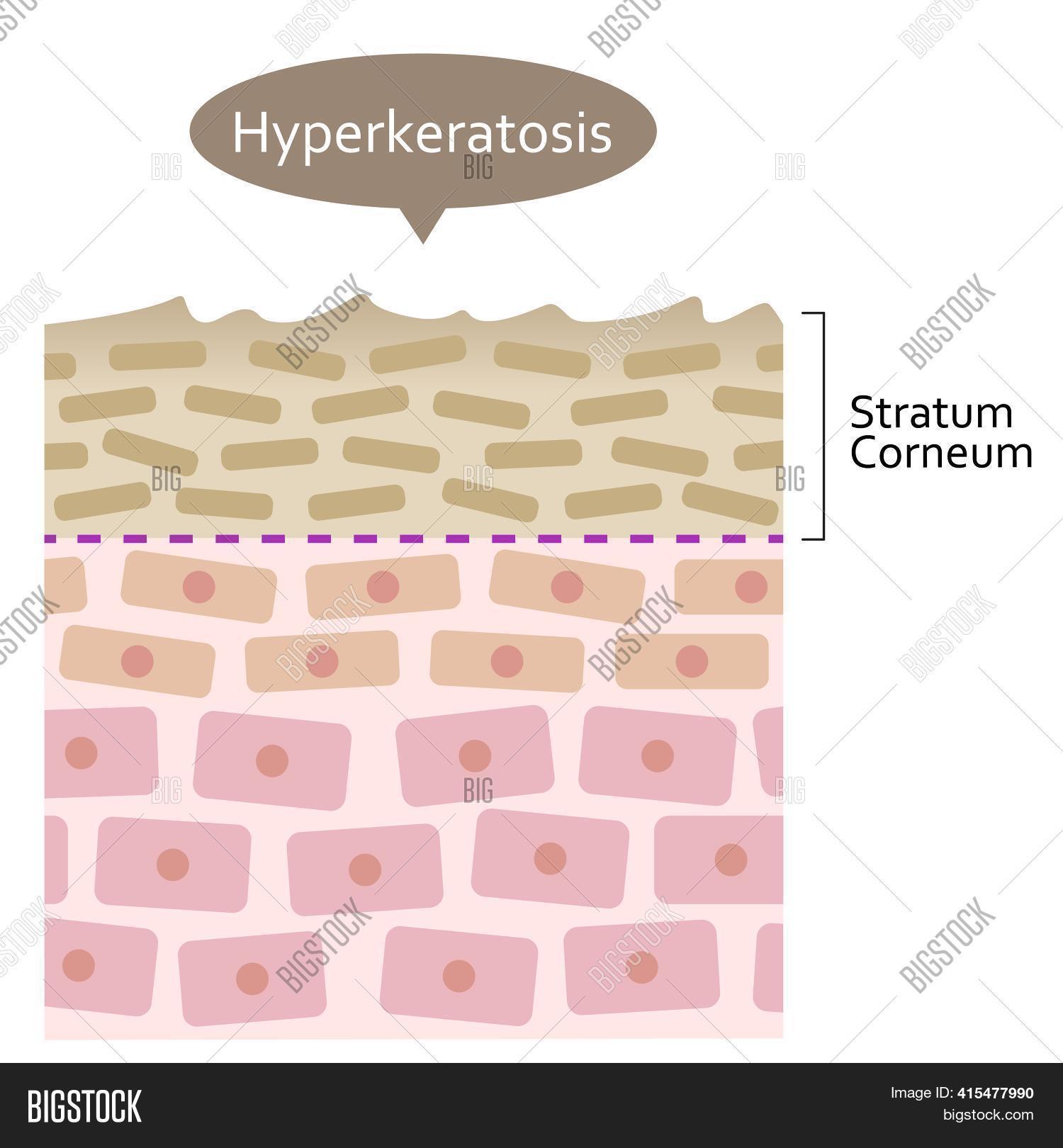 Diagram Skin Cell Image & Photo (Free Trial) | Bigstock