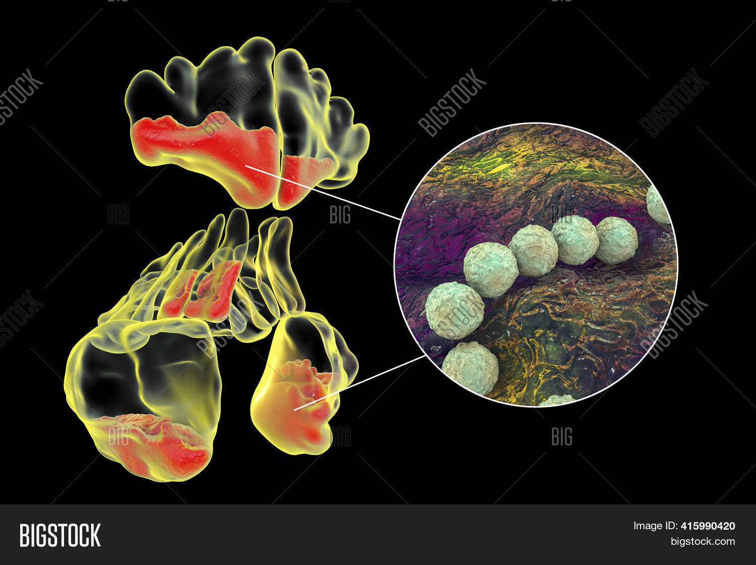 Streptococcus Pyogenes Image & Photo (Free Trial) | Bigstock