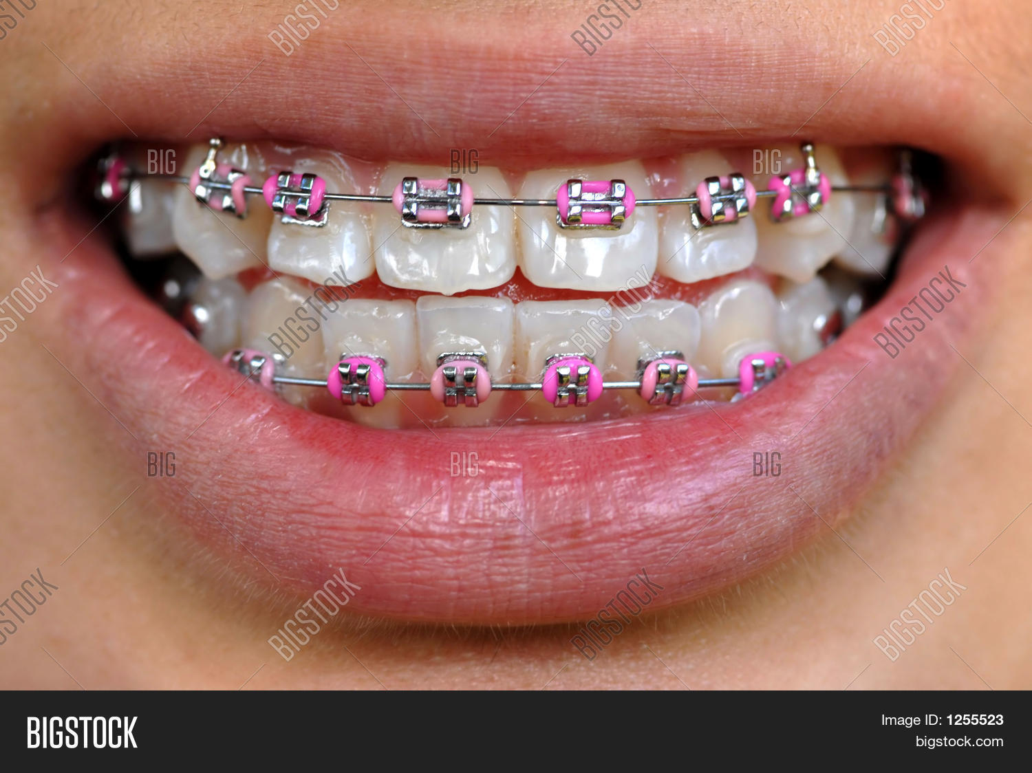 Pink Braces Image & Photo (Free Trial) | Bigstock