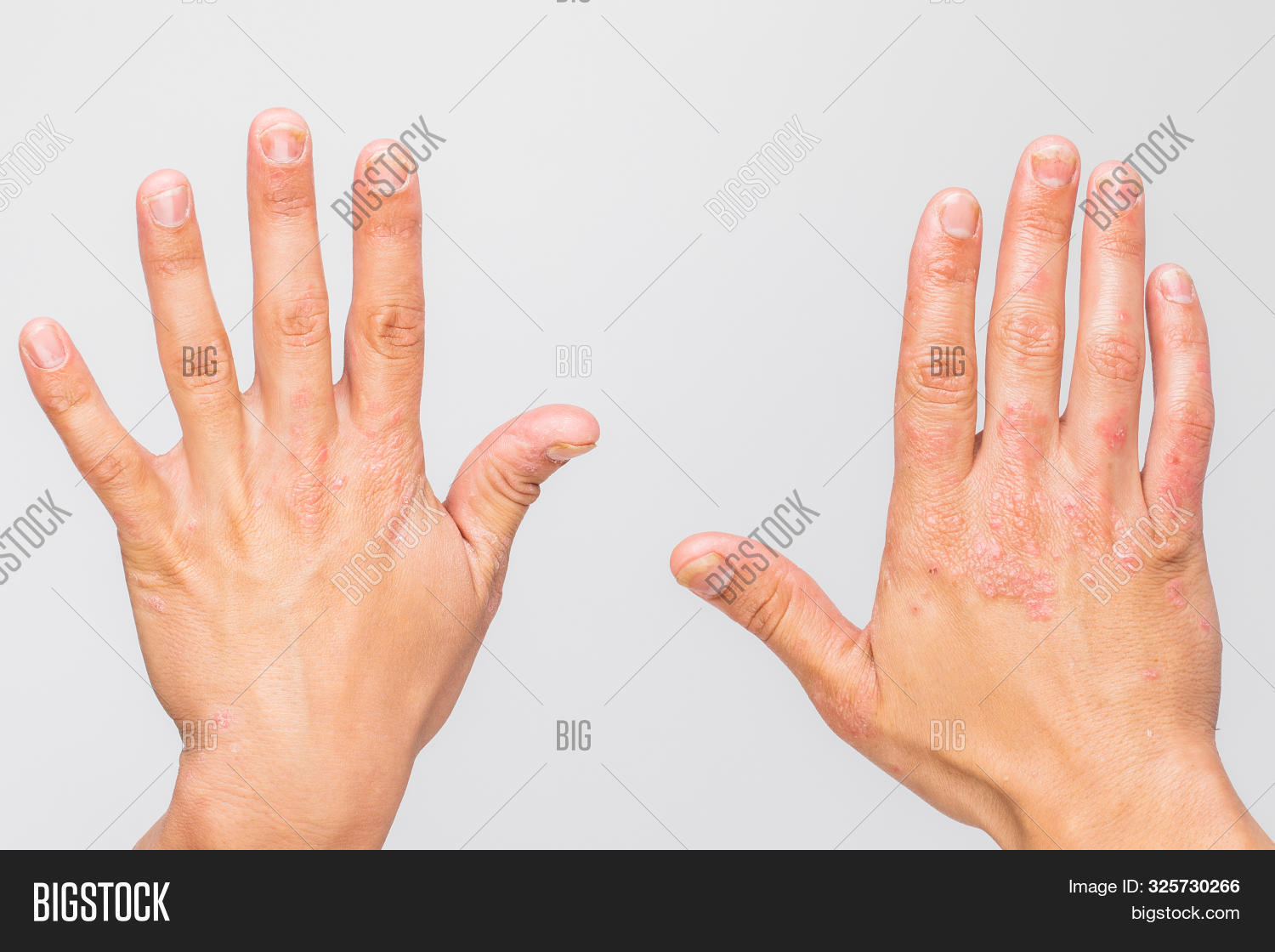 Man Sick Hands, Dry Image & Photo (Free Trial) | Bigstock