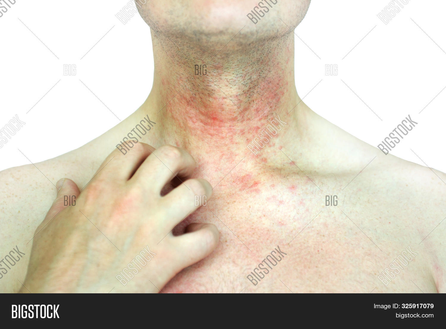 Atopic Dermatitis (ad Image & Photo (Free Trial) | Bigstock