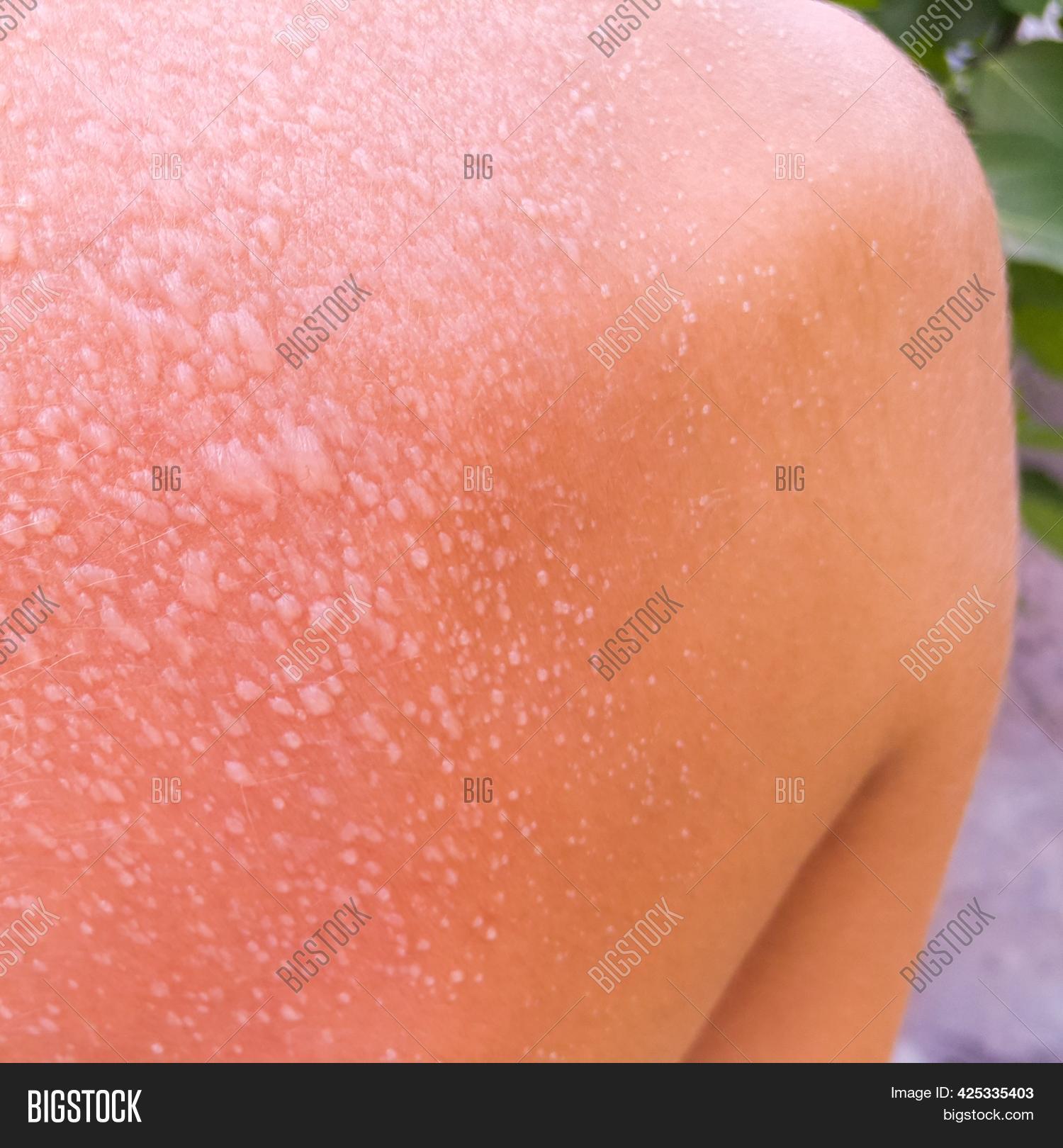 Blisters On Back Image & Photo (Free Trial) | Bigstock