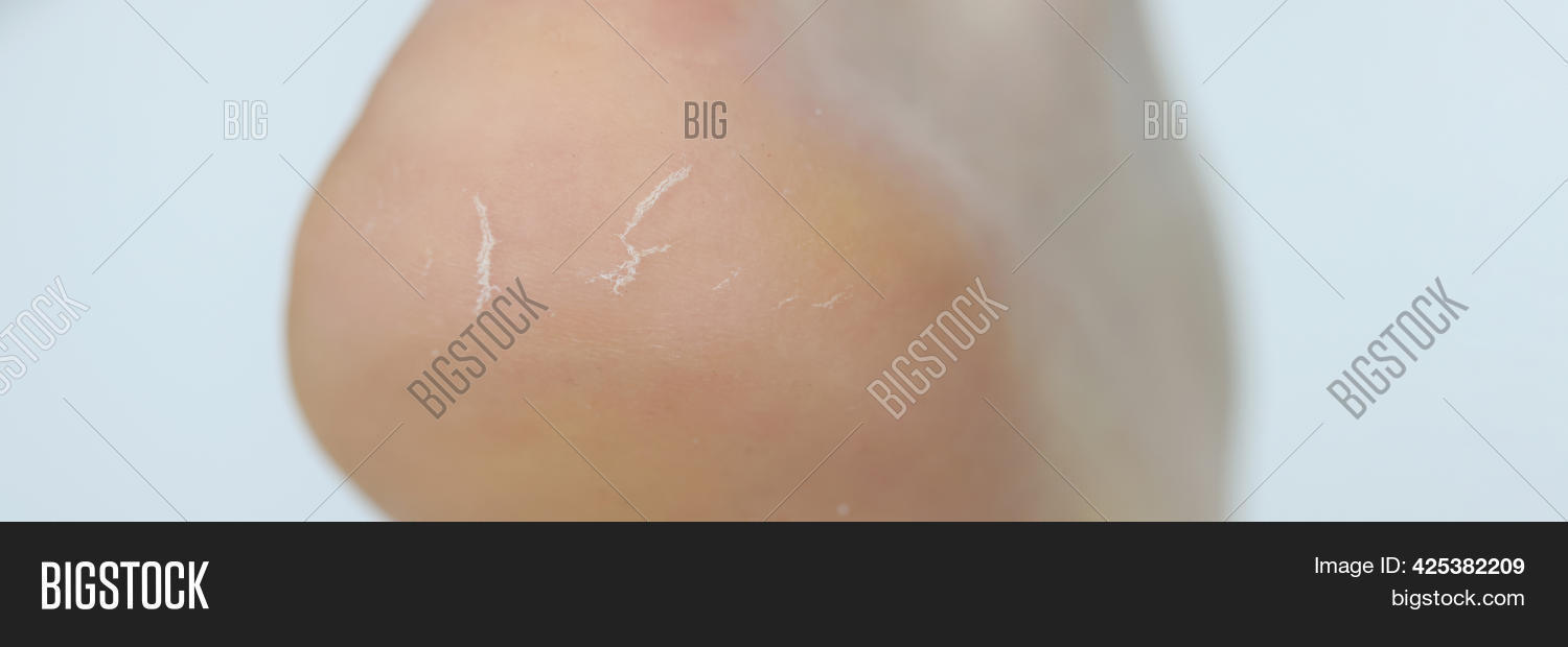 Human Heel Skin Image & Photo (Free Trial) | Bigstock