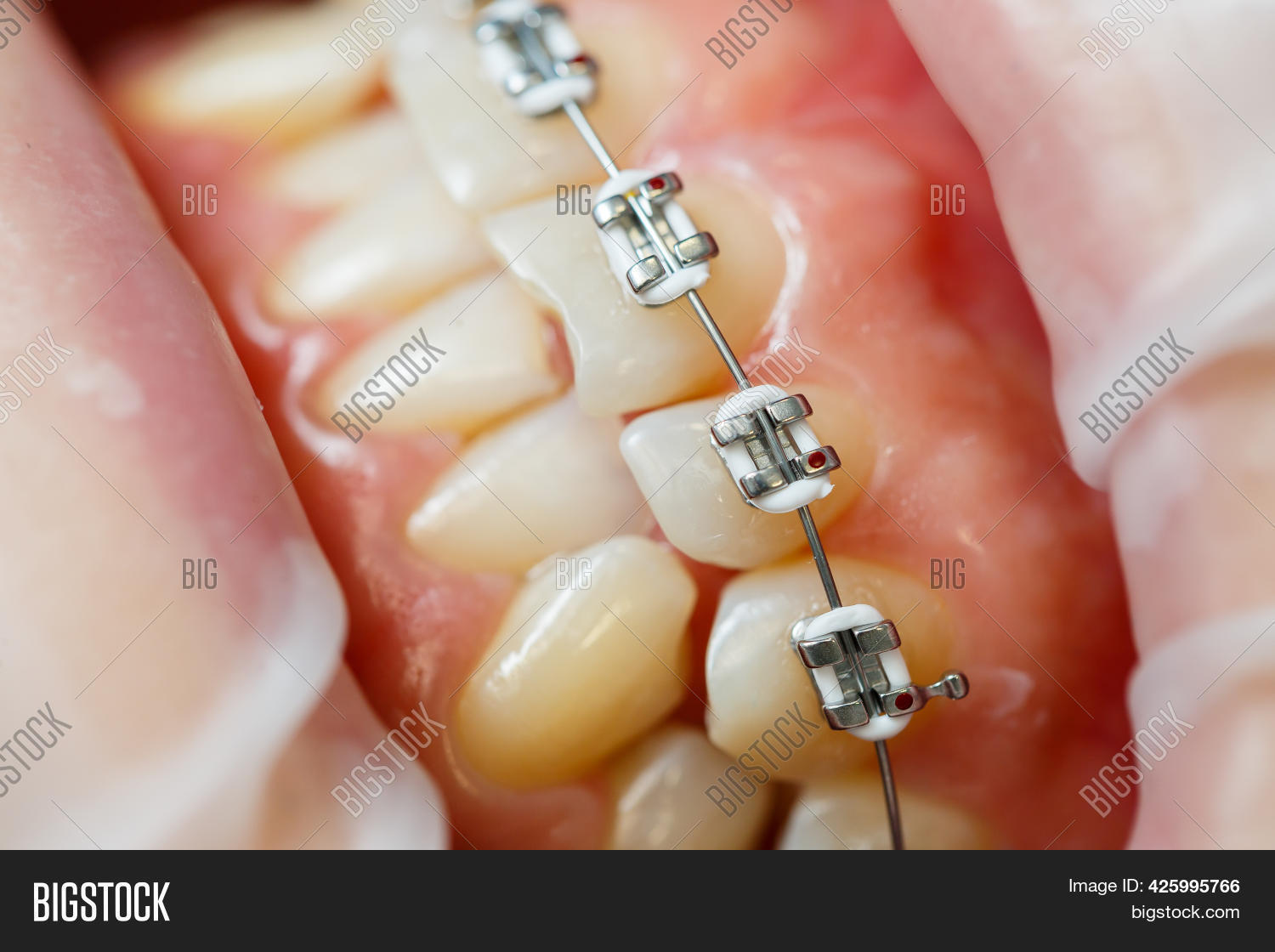 Installation Braces On Image & Photo (Free Trial) | Bigstock