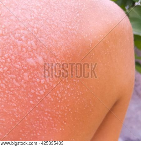 Blisters On Back Image & Photo (Free Trial) | Bigstock