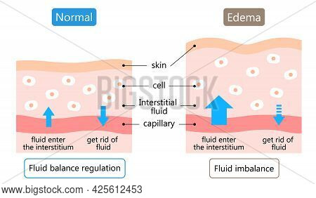 Diagram Edema Normal Image & Photo (Free Trial) | Bigstock