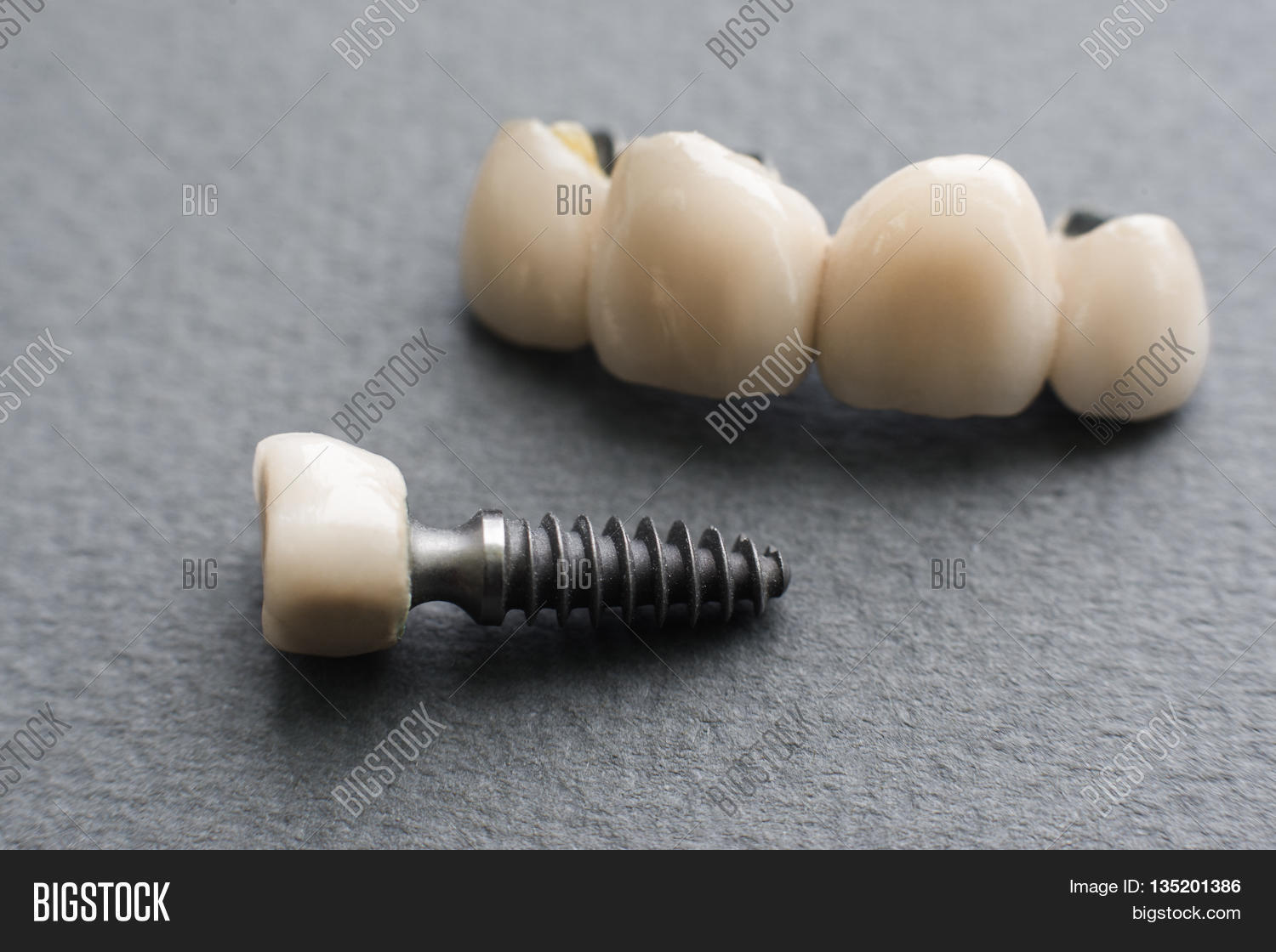 Single Denture Dental Image & Photo (Free Trial) | Bigstock