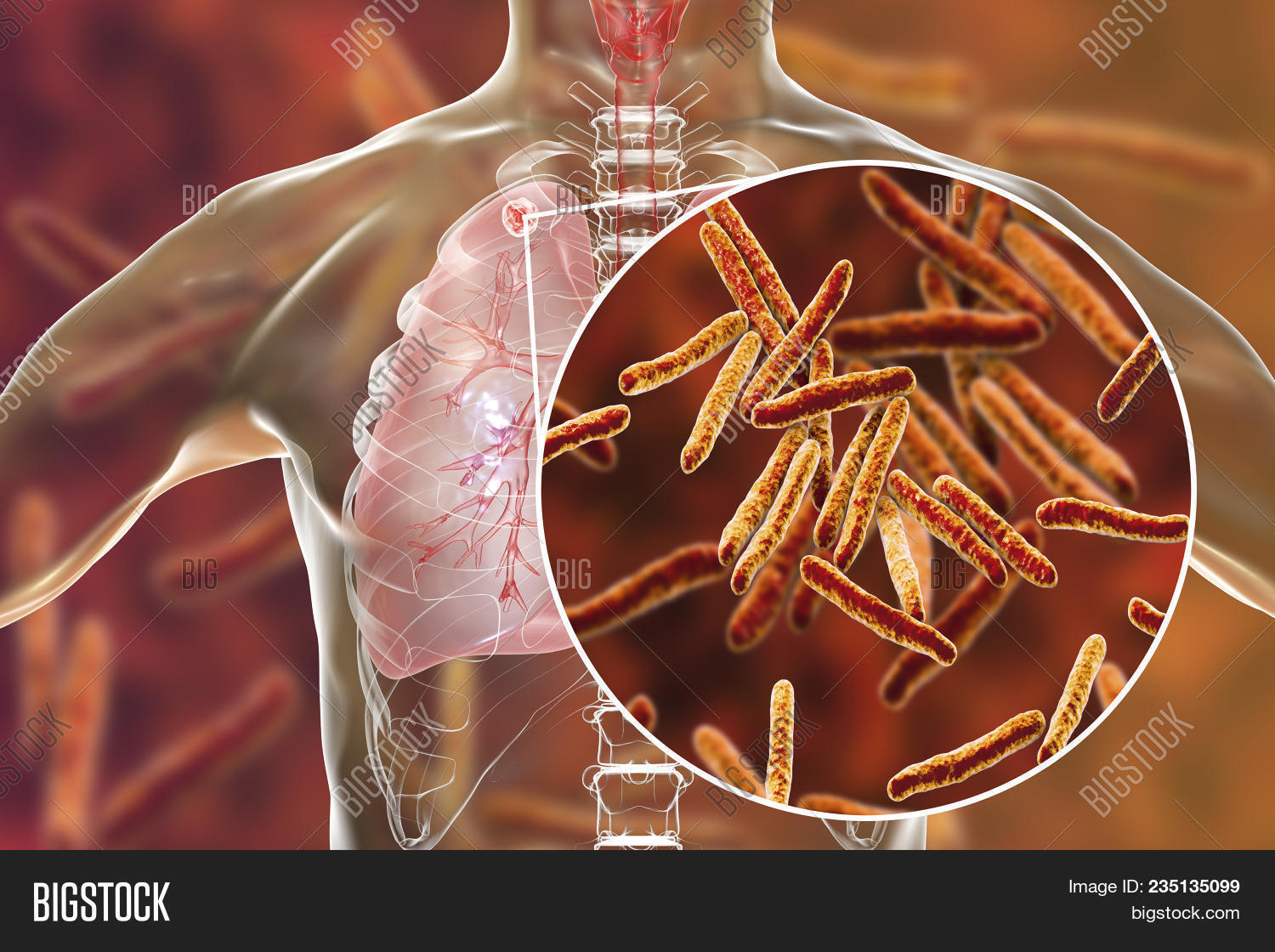 Secondary Tuberculosis Image & Photo (Free Trial) | Bigstock