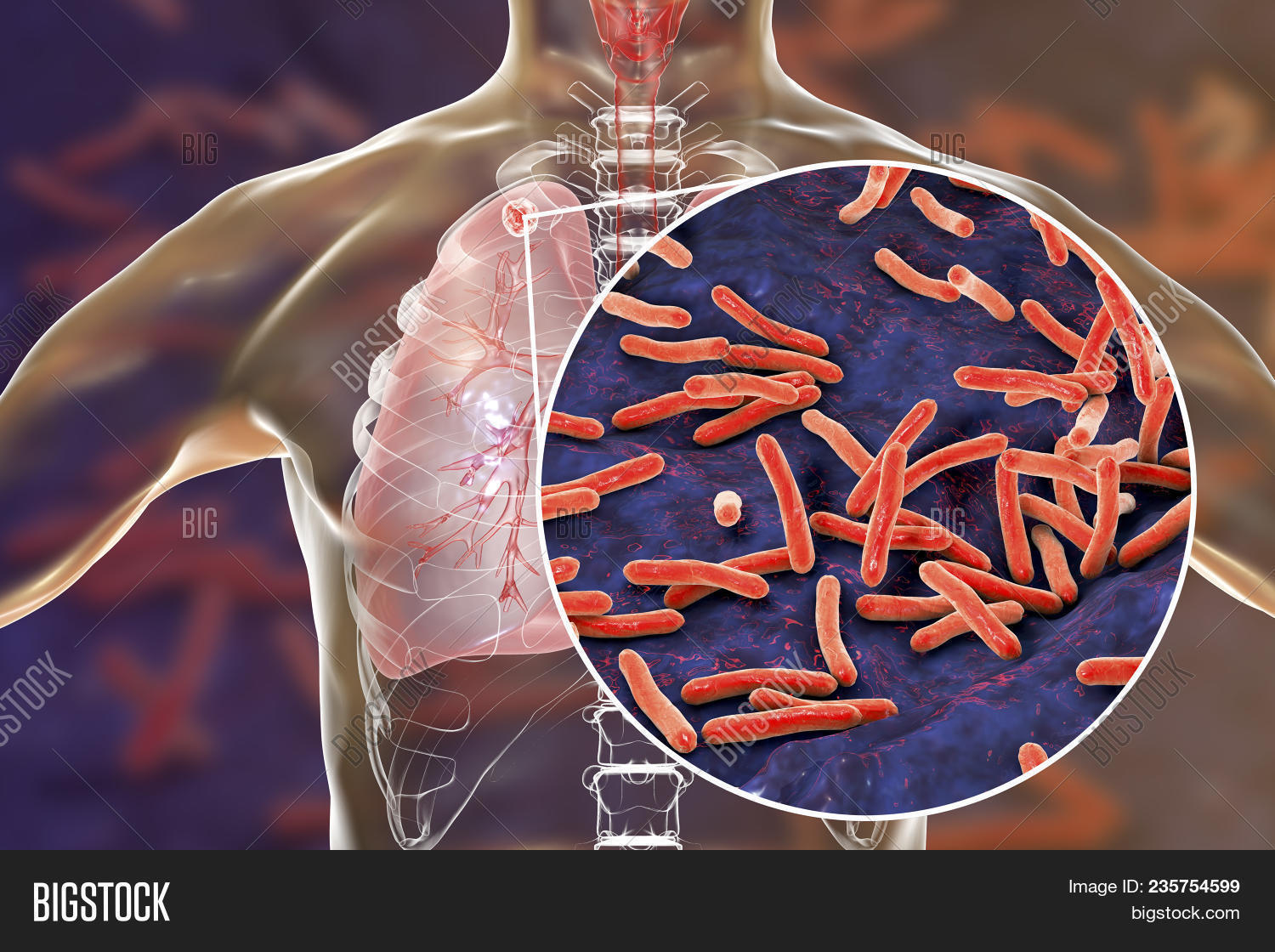Secondary Tuberculosis Image & Photo (Free Trial) | Bigstock
