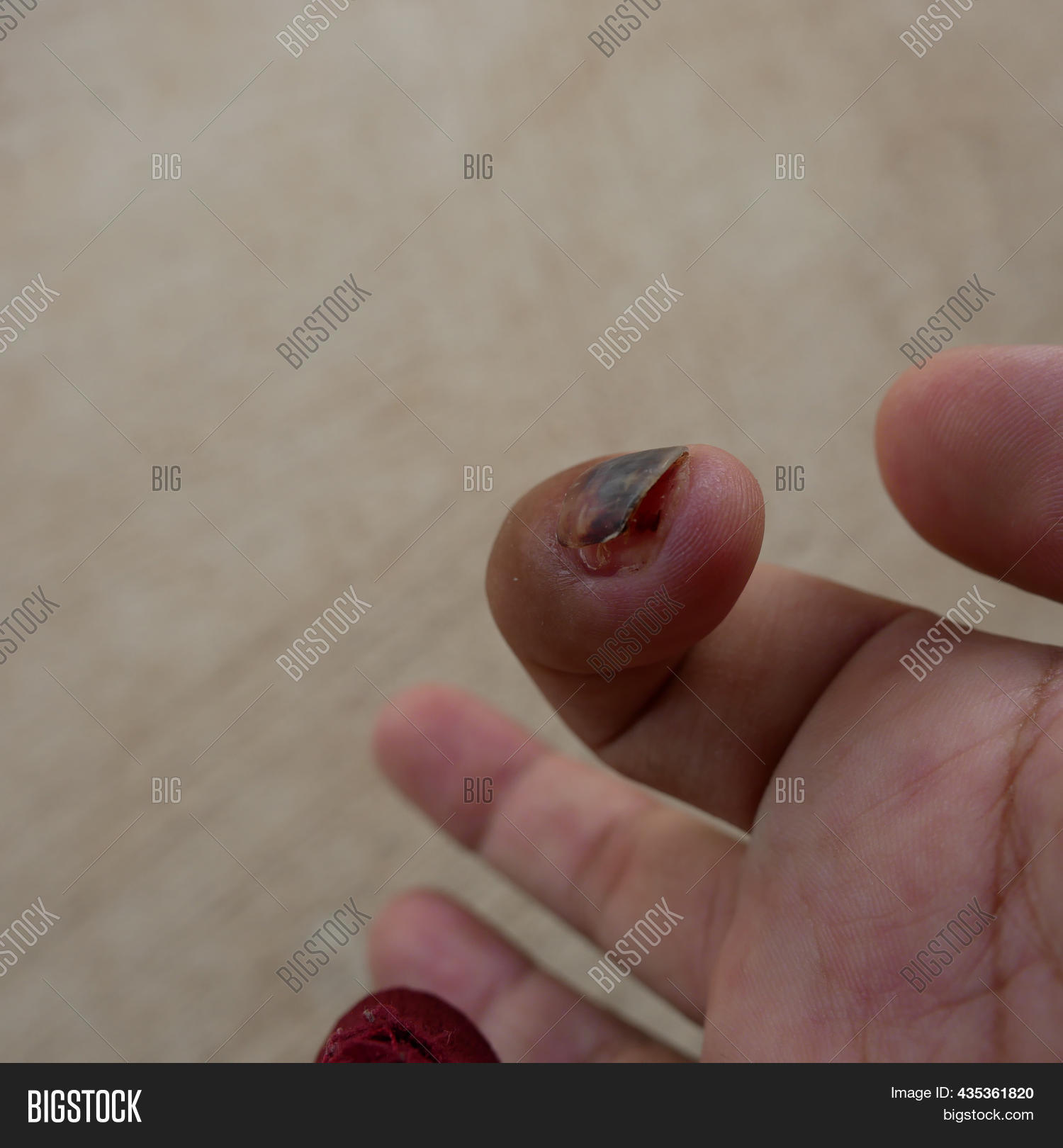 Accident Left Fingers Image & Photo (Free Trial) | Bigstock