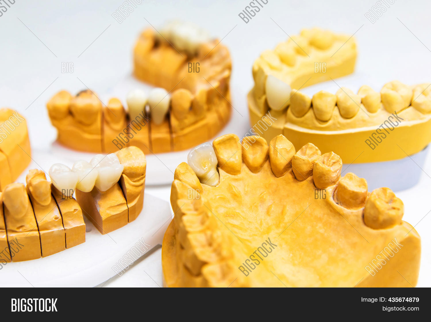 Dental Implants. Mock Image & Photo (Free Trial) | Bigstock
