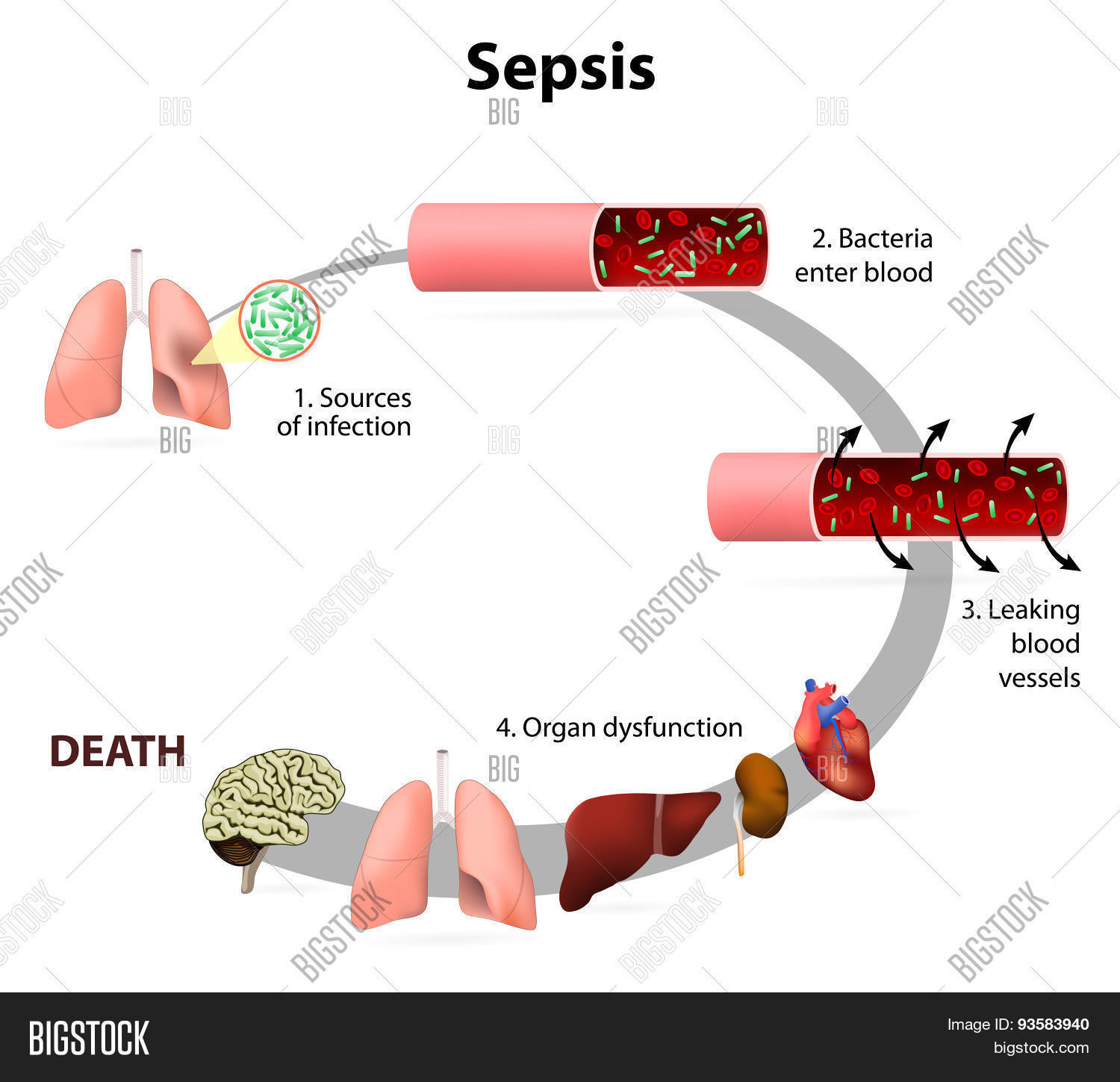 Sepsis Vector & Photo (Free Trial) | Bigstock