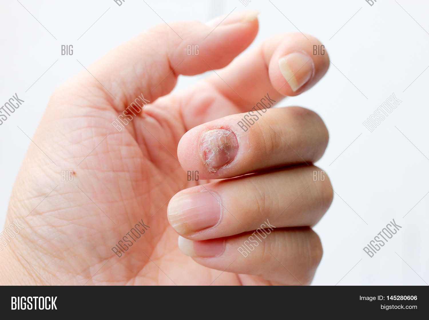Fungus Infection On Image & Photo (Free Trial) | Bigstock