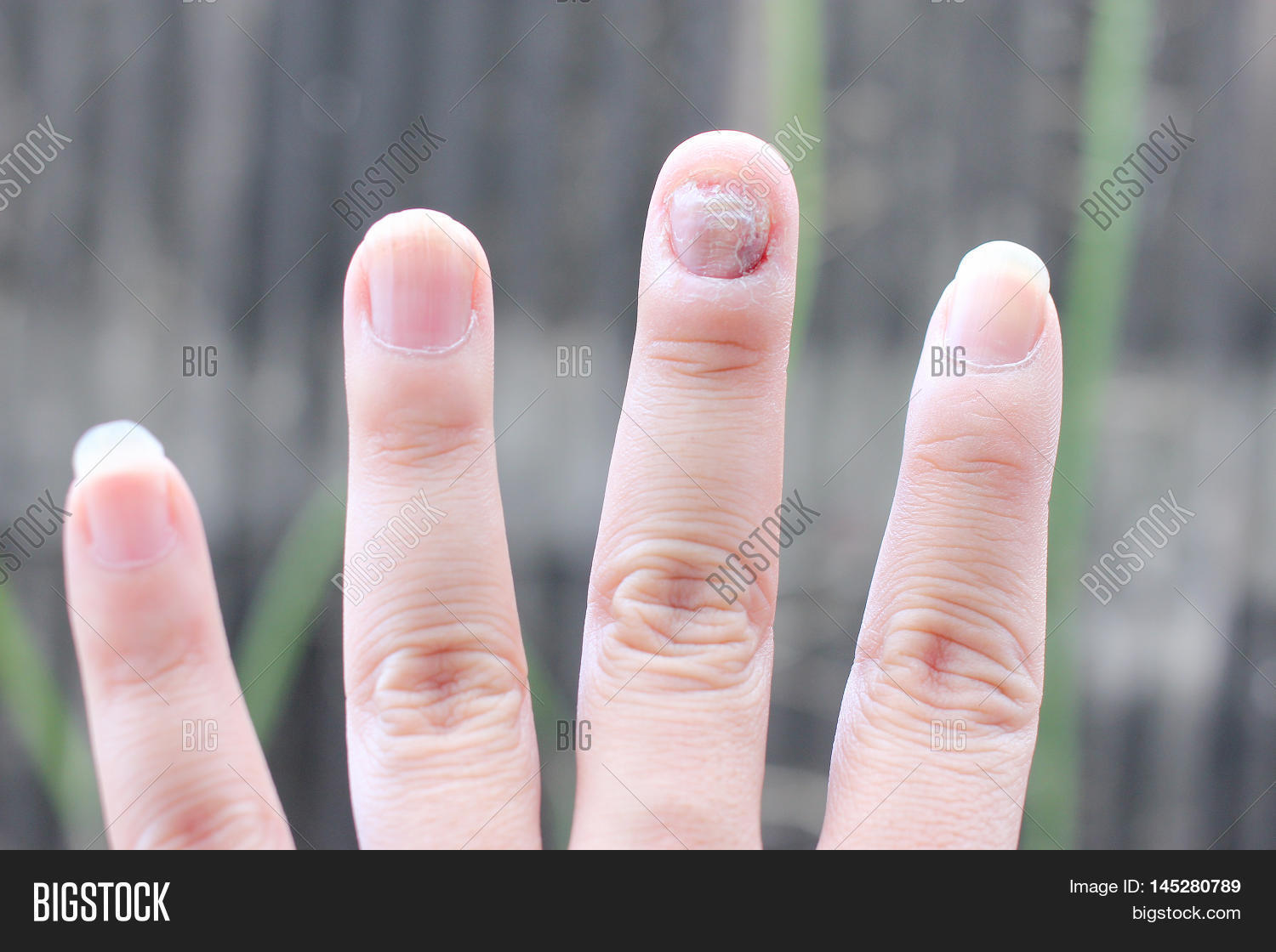 Fungus Infection On Image & Photo (Free Trial) | Bigstock