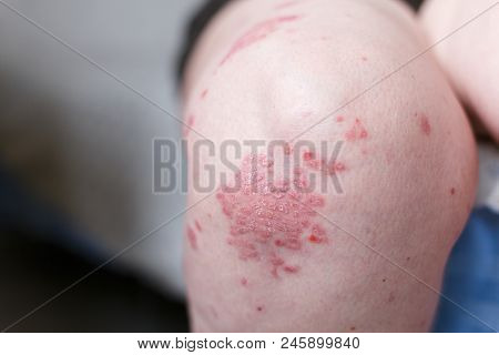 Allergic Rash Image & Photo (Free Trial) | Bigstock