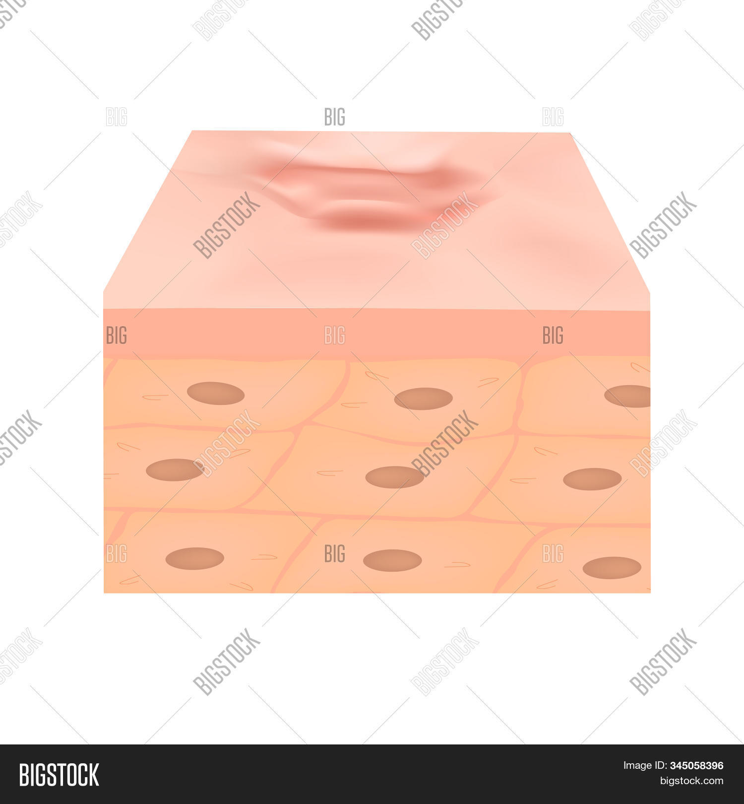 Scars Hypertrophic. Image & Photo (Free Trial) | Bigstock