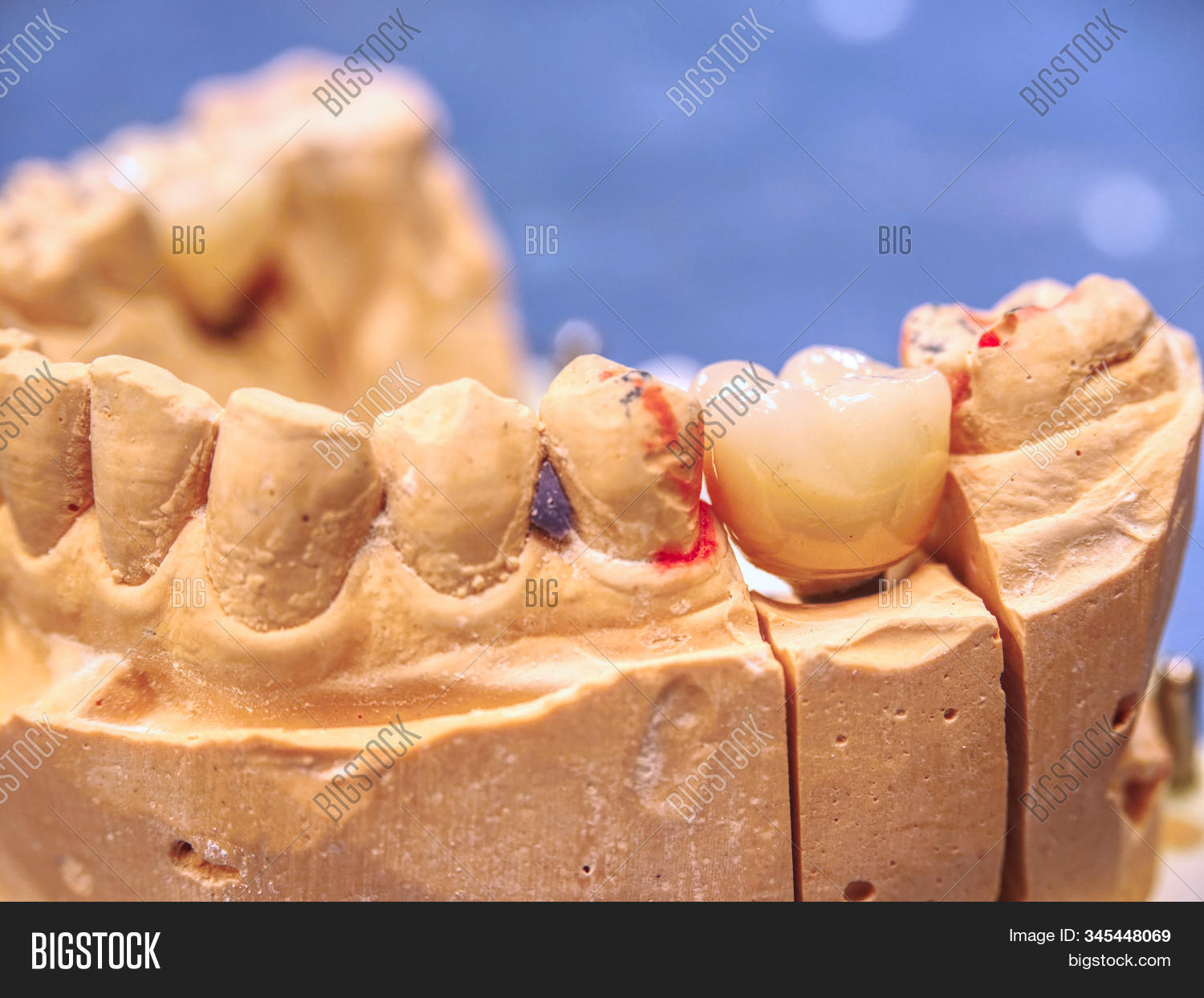 Dental Prosthesis Image & Photo (Free Trial) | Bigstock