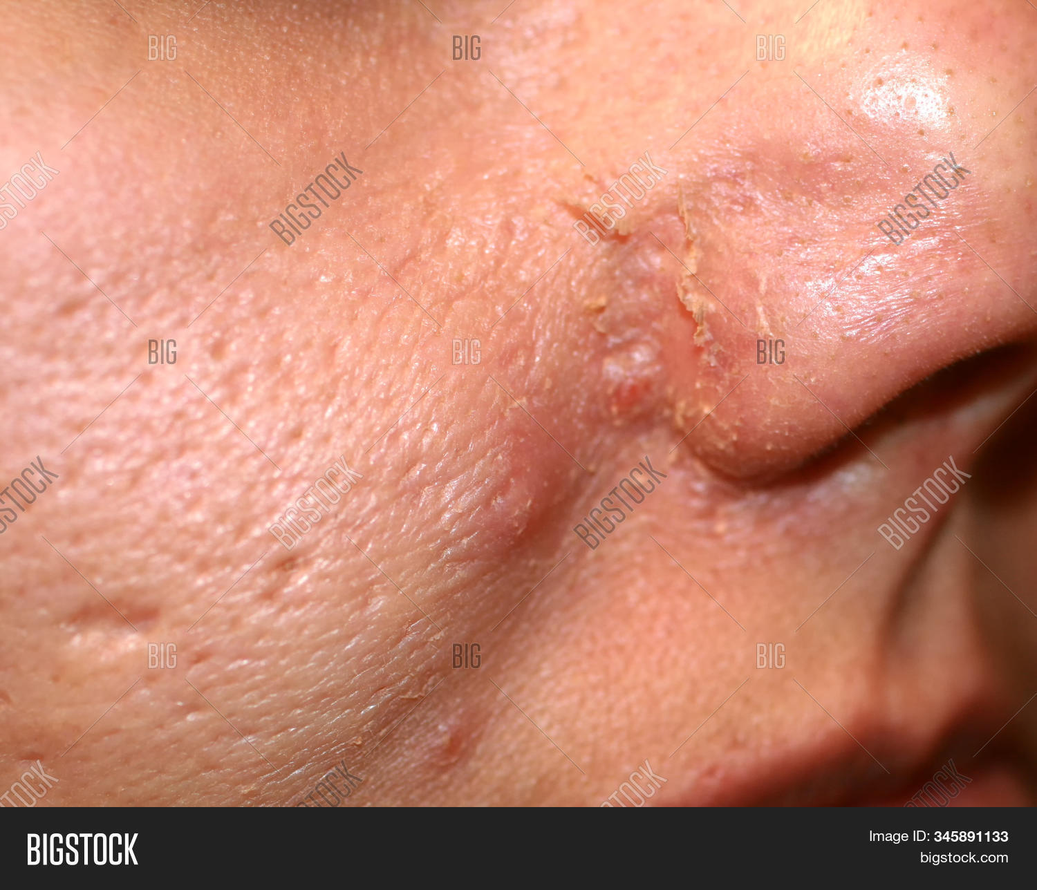 Inflamed Skin On Face Image & Photo (Free Trial) | Bigstock