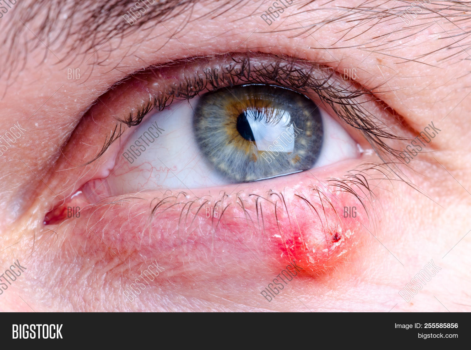 Stye (hordeolum) Image & Photo (Free Trial) | Bigstock