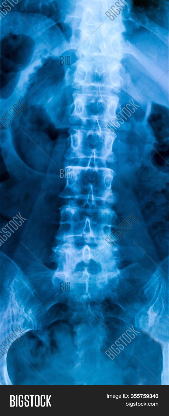 X-ray Bones Human Image & Photo (Free Trial) | Bigstock