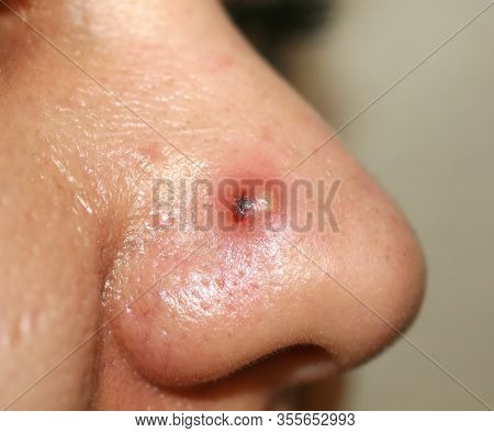 Inflamed Pimple On Image & Photo (Free Trial) | Bigstock