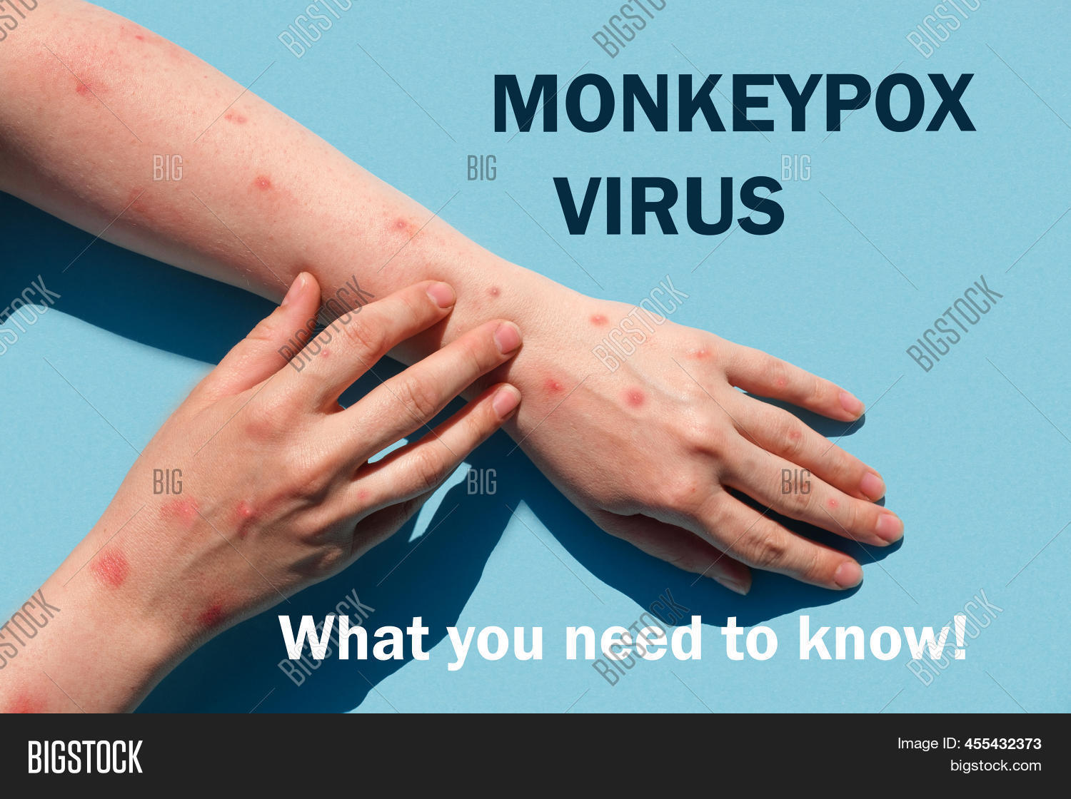 Phrase Monkeypox Virus Image & Photo (Free Trial) | Bigstock