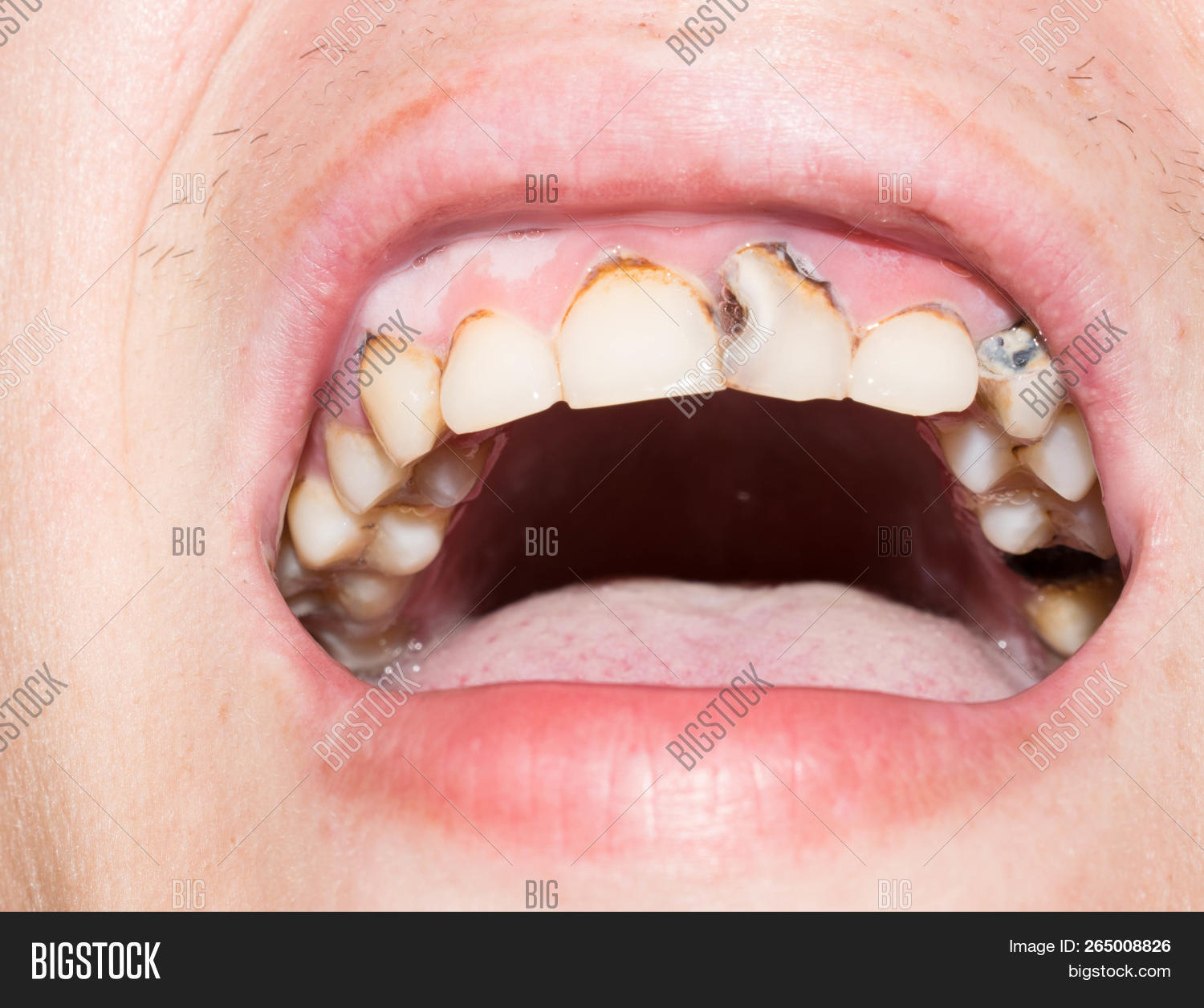 Teeth Adult Person Image & Photo (Free Trial) | Bigstock