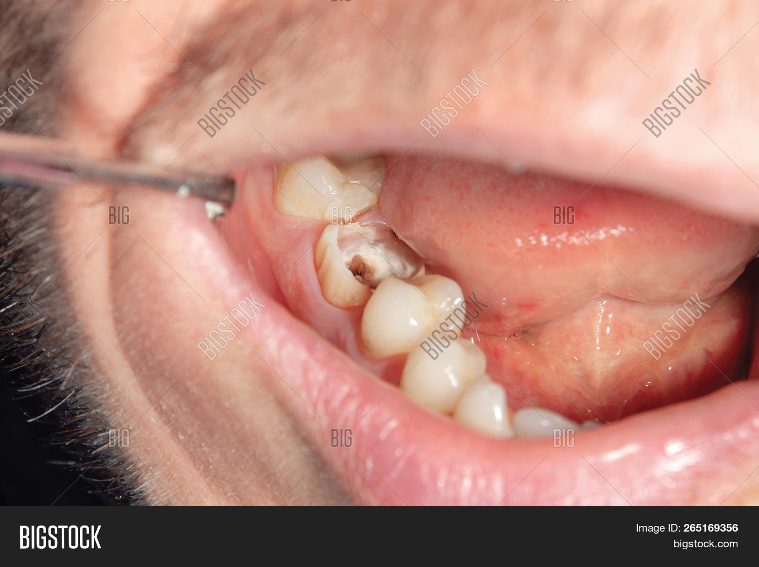 Dental Caries. Filling Image & Photo (Free Trial) | Bigstock