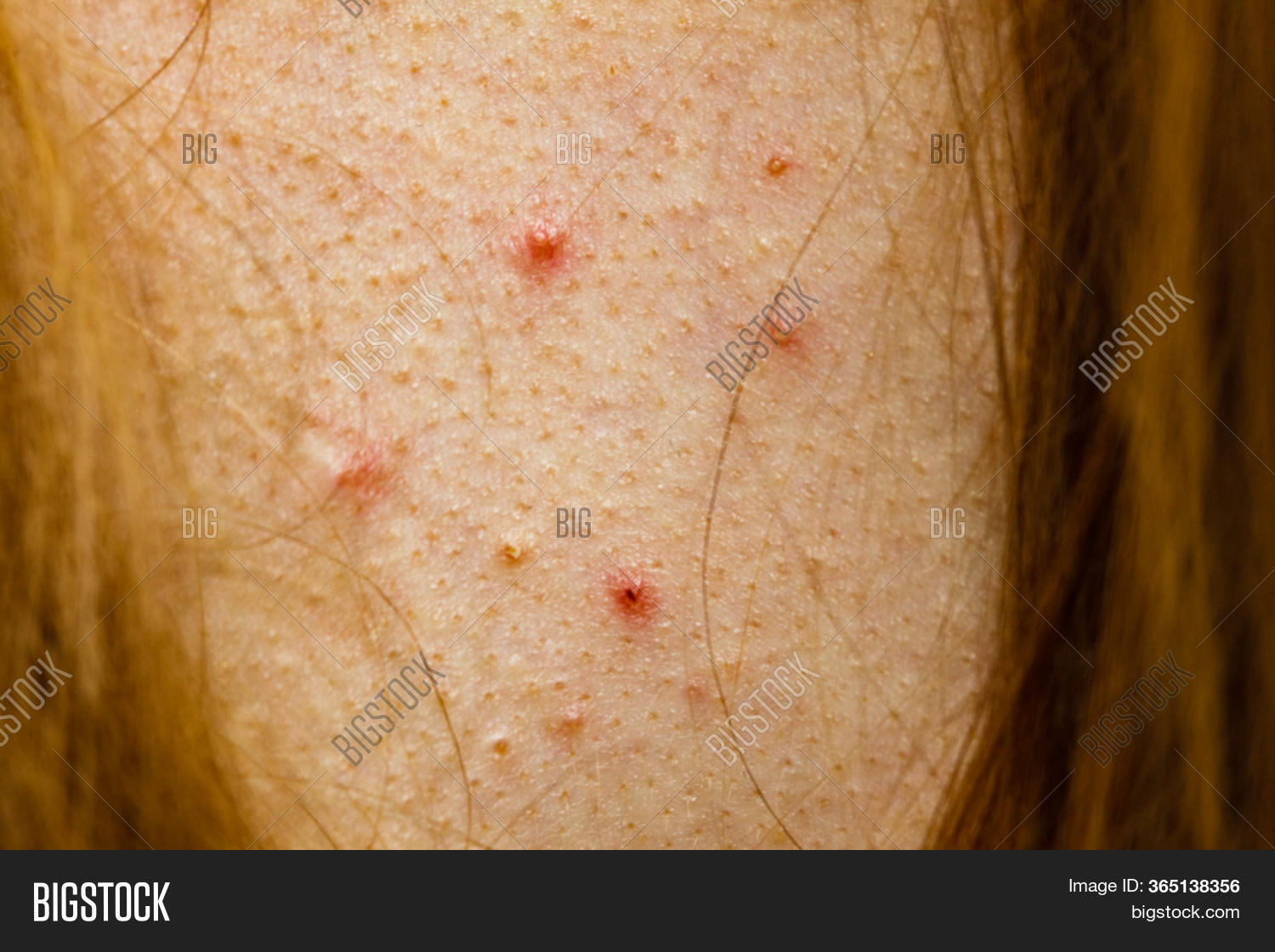 Closeup Skin Acne Image & Photo (Free Trial) | Bigstock