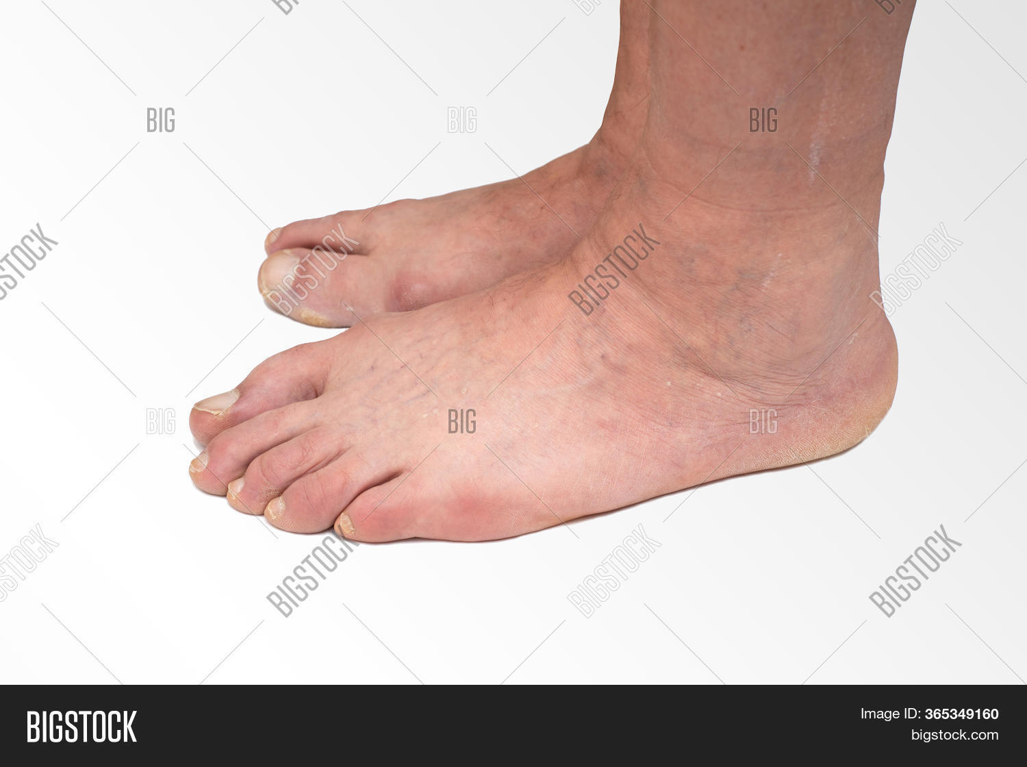 Varus Valgus Hallux Image & Photo (Free Trial) | Bigstock