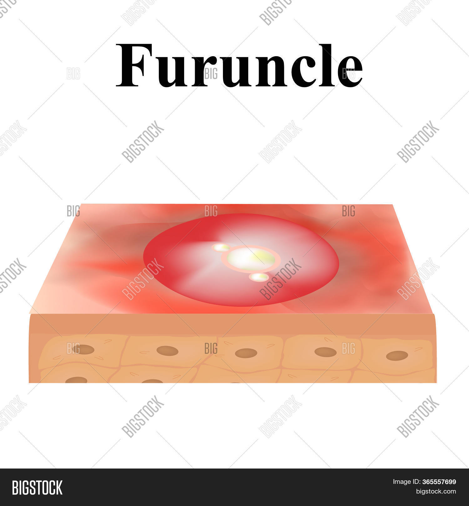 Cyst Acne. Furuncle Image & Photo (Free Trial) | Bigstock