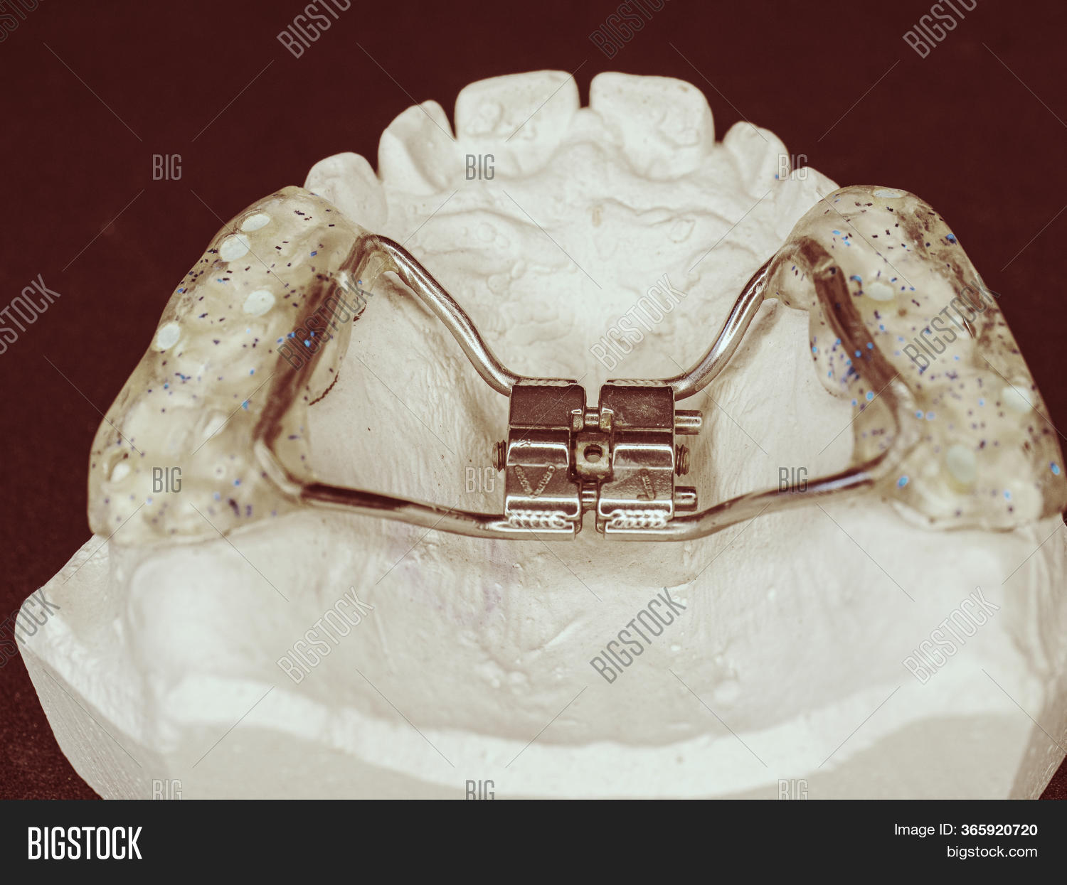 Dental Upper Jaw Image & Photo (Free Trial) | Bigstock